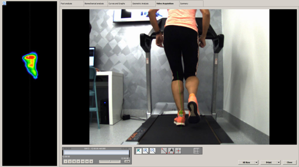 Computerized Gait Analysis - Feetology Podiatry Centre