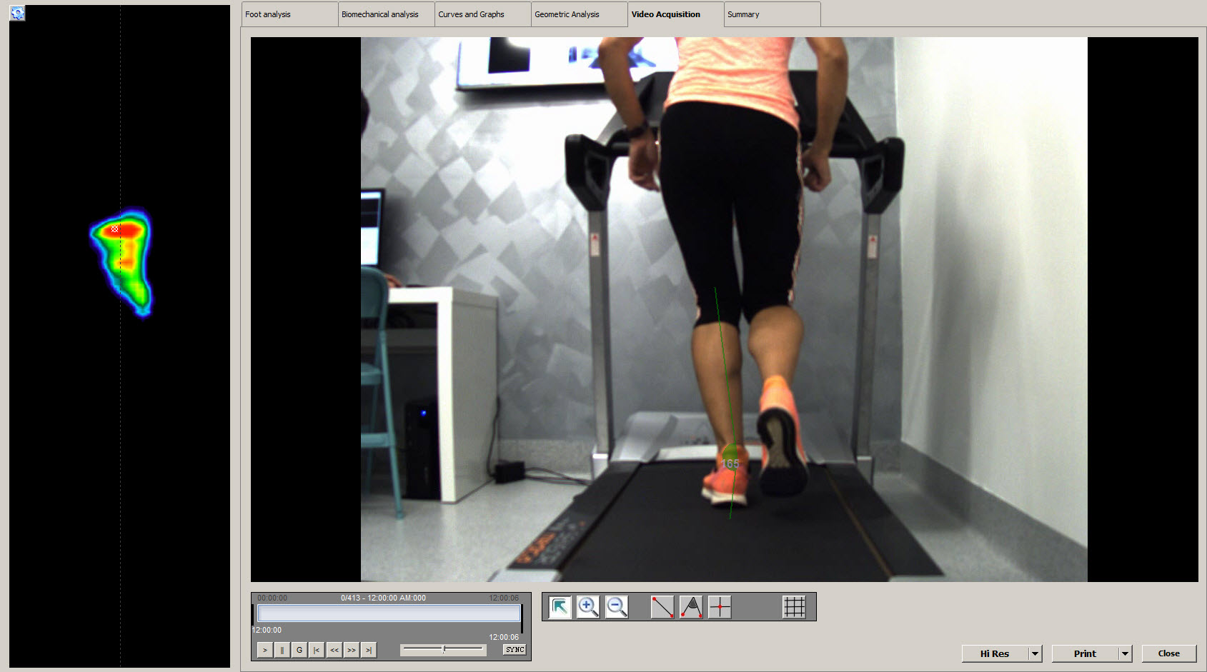 Computerized Gait Analysis - Feetology Podiatry Centre