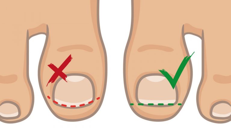 Wart Vs Corn - How Do You Tell The Difference - Feetology Podiatry Centre